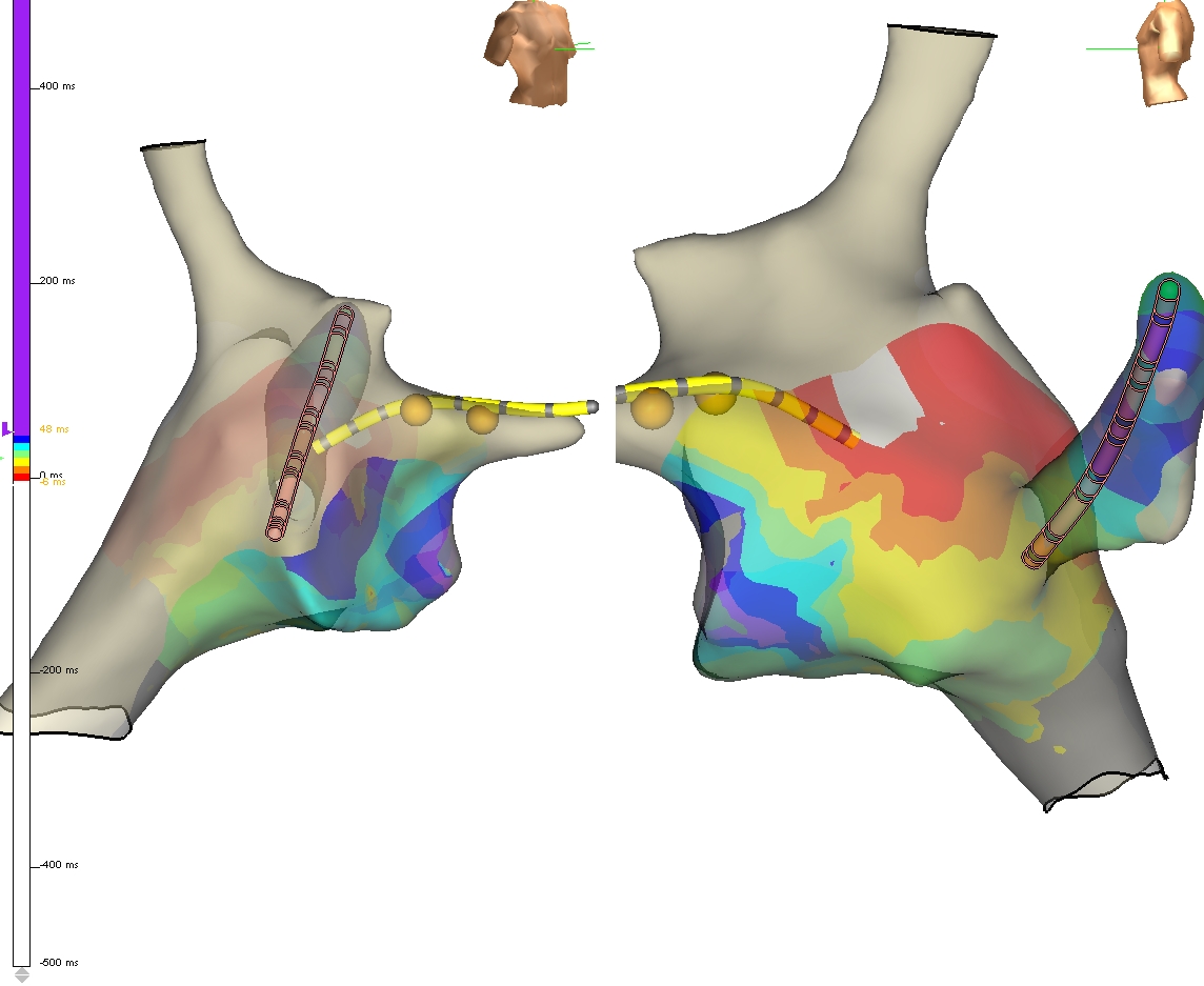 Additional Examples of the Voltage/Propagation mapping technique and ...
