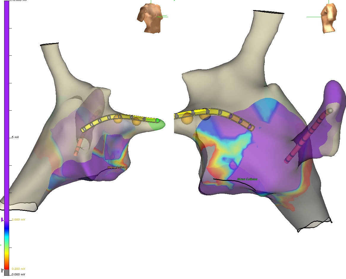 Additional Examples of the Voltage/Propagation mapping technique and ...